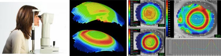 medmont-e300-corneal-topographer-3 | Accent Eye Care