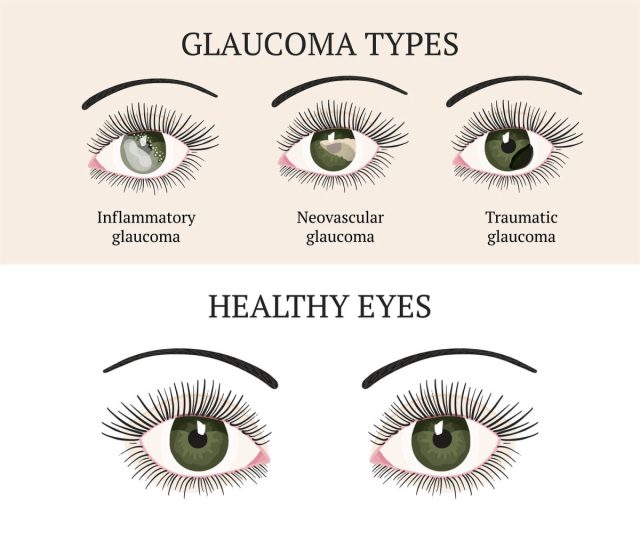 Glaucoma Chart | Accent Eye Care
